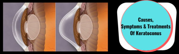 Causes Treatment And Stages Of Keratoconus Clearvision
